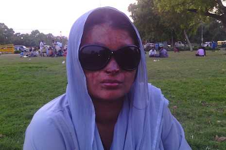 Acid attacks in India on the rise - UCA News